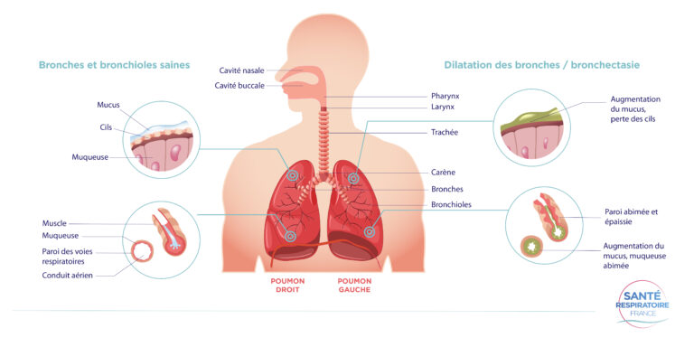 La dilatation des bronches (DDB) - Association Santé Respiratoire France